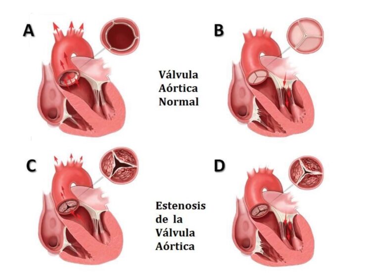 Valvulopatías - MIOCARDIO